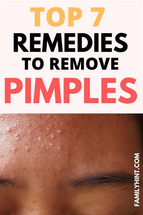 How To Get Rid Of Pimples Overnight 11 Effective Ways Artofit