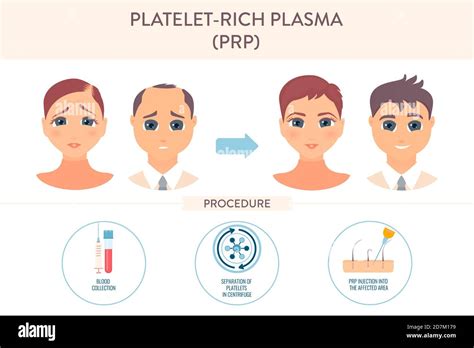 Platelet Rich Plasma Prp Treatment Conceptual Illustration Stock