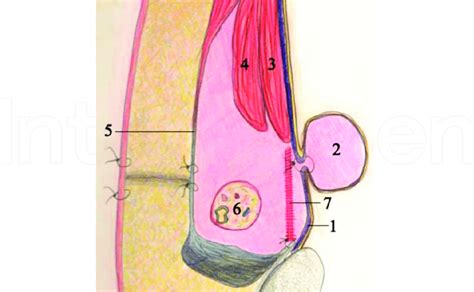 1 Transversalis Fascia 2 Reduced Direct Inguinal Hernia Latened By