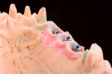 Figure 1 From Three Dimensional Scanning Accuracy Of Intraoral Scanners For Dental Implant Scan