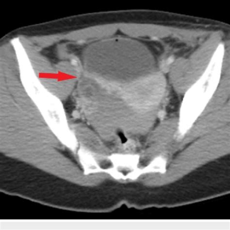 Ct Scan Demonstrating Complex Cystic Mass Of The Right Adnexa Red
