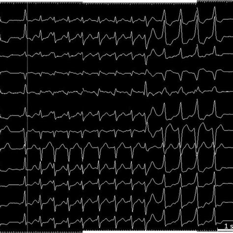 Typical Avnrt Showing Pseudo R In V1 And Pseudo S In Inferior Leads