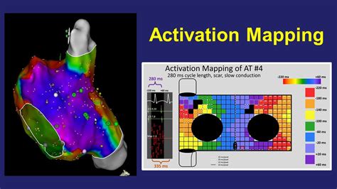 Activation Mapping Basic Concepts Pitfalls And Windowing YouTube