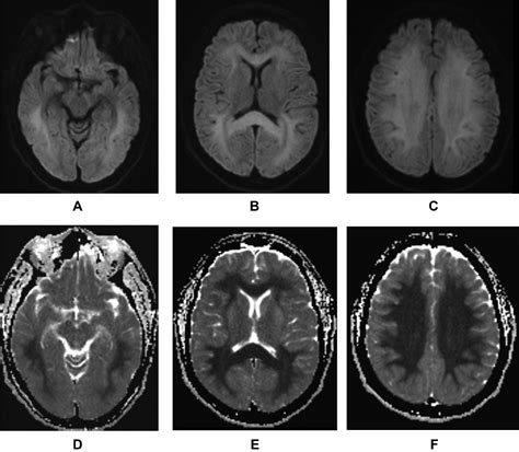 Infrequent Case Of Leucoencephalopathy After Electric Shock Trauma