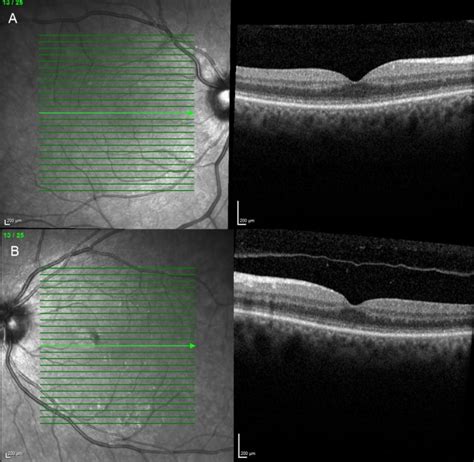 Cancer Associated Retinopathy In Ampullary Pancreatic Cancer Pmc