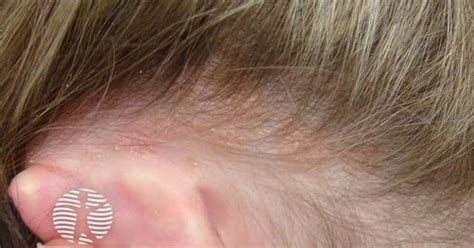 Psoriasis Of The Scalp Image