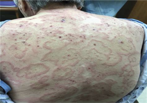 Persistent Arcuate Annular Rash Challenge The American Journal Of Dermatopathology