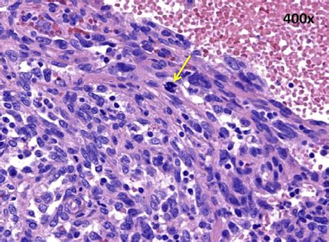 High Power View 400 × Hande Stained Section Of The Splenectomy