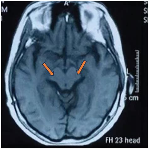 Axial T1 Weighted Mri Of The Brain Showing Mild Hyperintensity Of