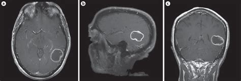 Mri Showing A 3 Cm Heterogeneously Enhancing Cystic Mass In The