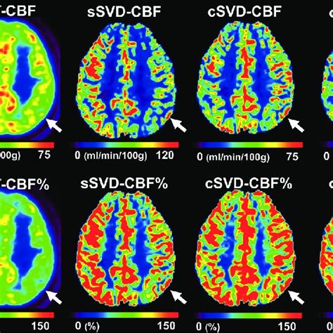 Suzuki Grading System Of Moyamoya Disease Download Scientific Diagram