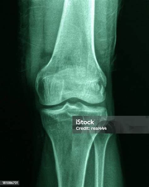 Knee Xray Bones Human Leg Anatomy 照片檔及更多 健康的生活方式 照片 健康的生活方式 軟骨