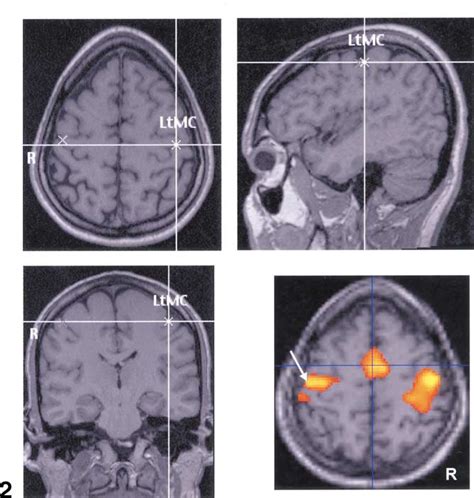 Figure 2 From Ipsilateral Motor Cortex Activation On Functional Magnetic Resonance Imaging