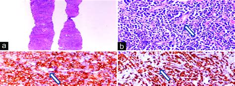 Histopathology Of The Lesion A Low Power View Showing Two Cores Of
