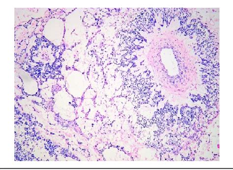Figure 1 From Malignant Mixed Germ Cell Tumor Overgrowing A