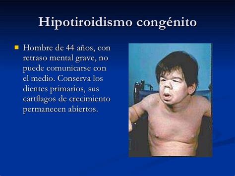 Hipotiroidismo Congenito