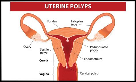 Uterine Polyps Causes Risk Factors Symptoms Treatment