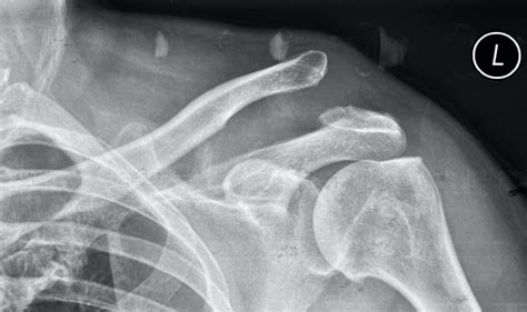 Ac Joint Separation Symptoms And Treatments Dr Eric Giang