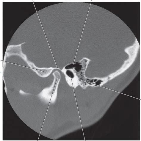 Diagram Of Labelling Sagittal CT Of Temporal Bone Quizlet