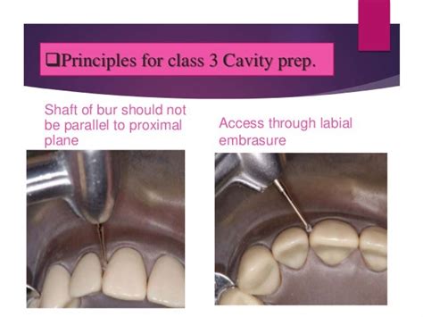 Class Iii Cavity Preparation