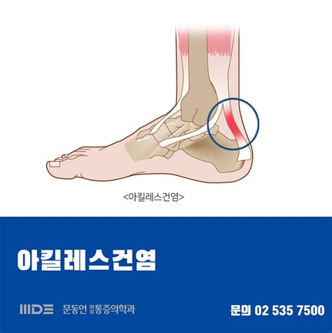 발뒤꿈치 통증 아킬레스건염 치료 네이버 포스트