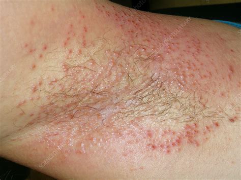 Contact Dermatitis Stock Image C061 1495 Science Photo Library