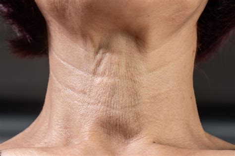 Neck Lines Causes And Treatment