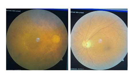 Neovascular Glaucoma Pptx Ppt