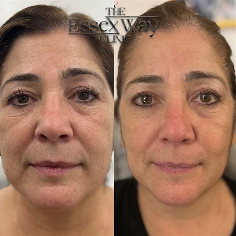 Hifu Treatment Essex 3d Hifu Non Surgical Facelift Essex Way Clinic