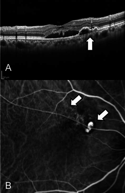 Intraocular Inflammation Following Faricimab Intravitreal Injection Treated With Sub Tenon