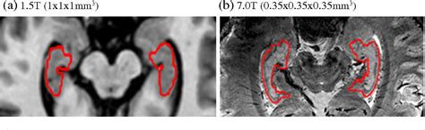Figure From Automatic Hippocampus Segmentation Of Tesla Mr Images