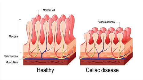Celiac Disease Signs Symptoms and Diagnosis Everyday Health BOB电竞手机APP