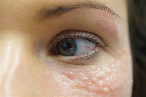 Mezoterapia igłowa pod oczy cena opinie efekty MediWell Beauty