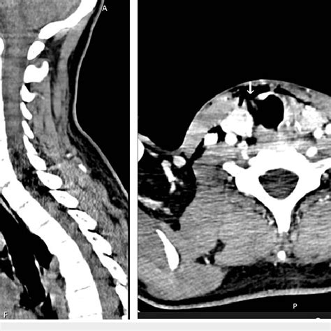 Sagittal Computerized Tomography Scan Showing Tracheal Laceration