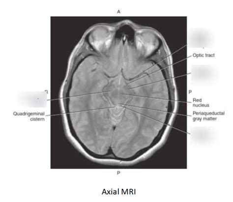 Substantia Nigra Mri