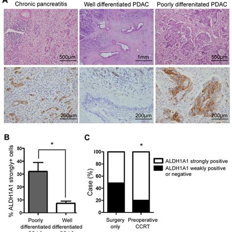 Ihc Analysis Of Aldh1a1 In Surgical Specimens From Human Pdac A Ihc