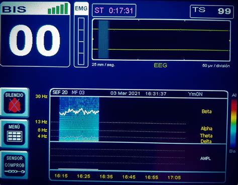 Effect Of Anesthetics On Electroencephalography Part 2