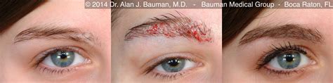 How Much Is A Eyebrow Transplant Eyebrowshaper