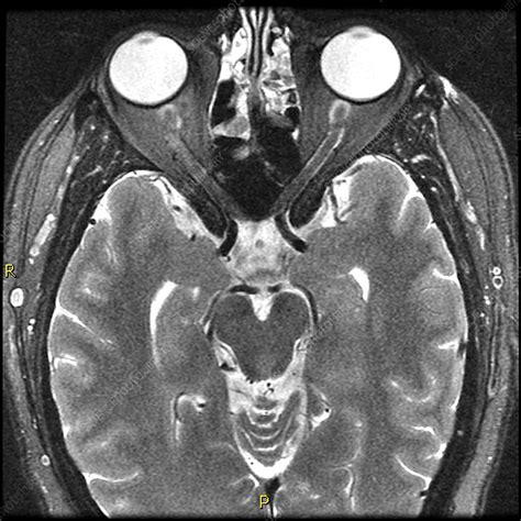 Optic Neuritis Mri Stock Image C027 1854 Science Photo Library