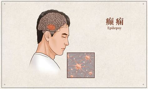 世界癫痫日 科学防治 规范诊疗 告别癫痫 上海蓝十字脑科医院官网 同济大学附属脑科医院筹