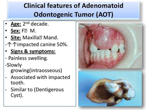 Odontogenic Tumors
