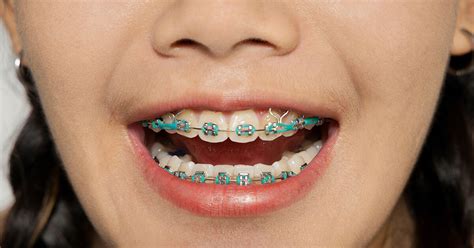 Orthodontic Bands For Braces