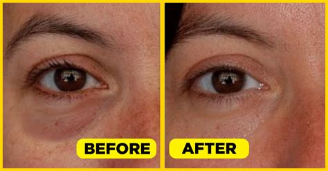 Eye Puffiness Treatment In Hindi At Gerard Becker Blog