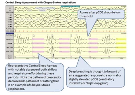 Pulmonology Sleep Apnea Syndrome Flashcards Quizlet