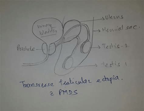 Male Variant Of Transverse Testicular Ectopia Download Scientific Diagram