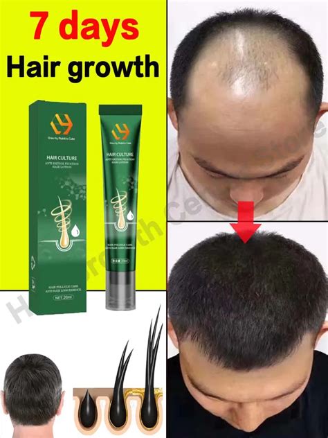 Hair Growth Oil Fast Hair Growth Effective Baldness Repair Hereditary