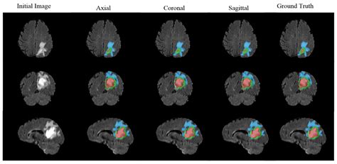 Biomedical Image Segmentation Using Denoising Diffusion Probabilistic