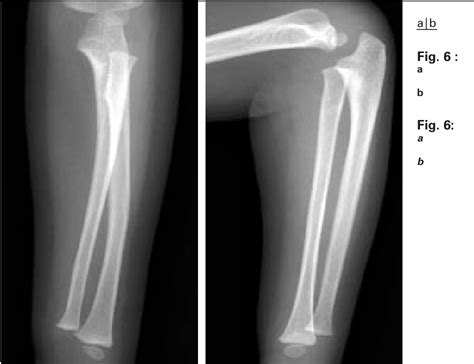 Plastic Bowing Fracture