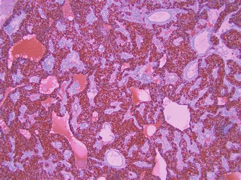 Cystic Parathyroid Adenoma Pth100 Positive Pth In Adenoma Cells On
