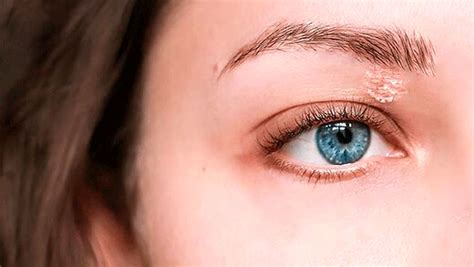 بیماری پسوریازیس چیست و چه علائمی دارد؟